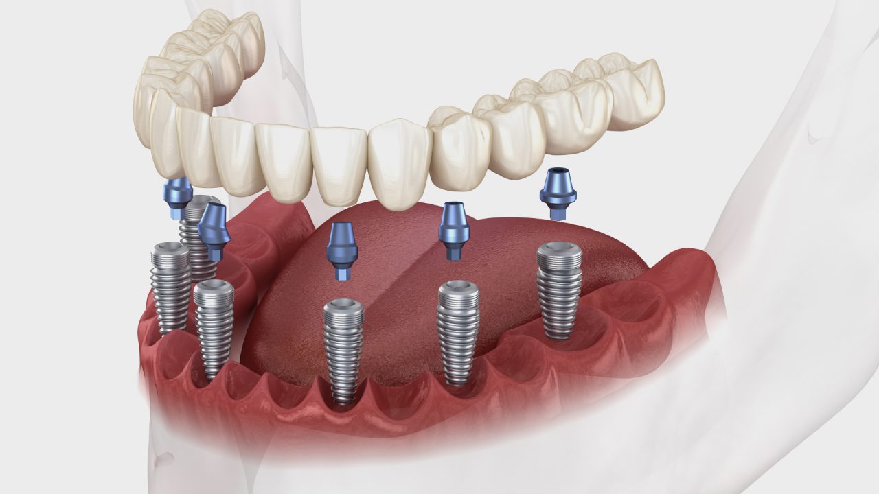 Basal Implants | Million Smiles Dental Clinic & Implant Center